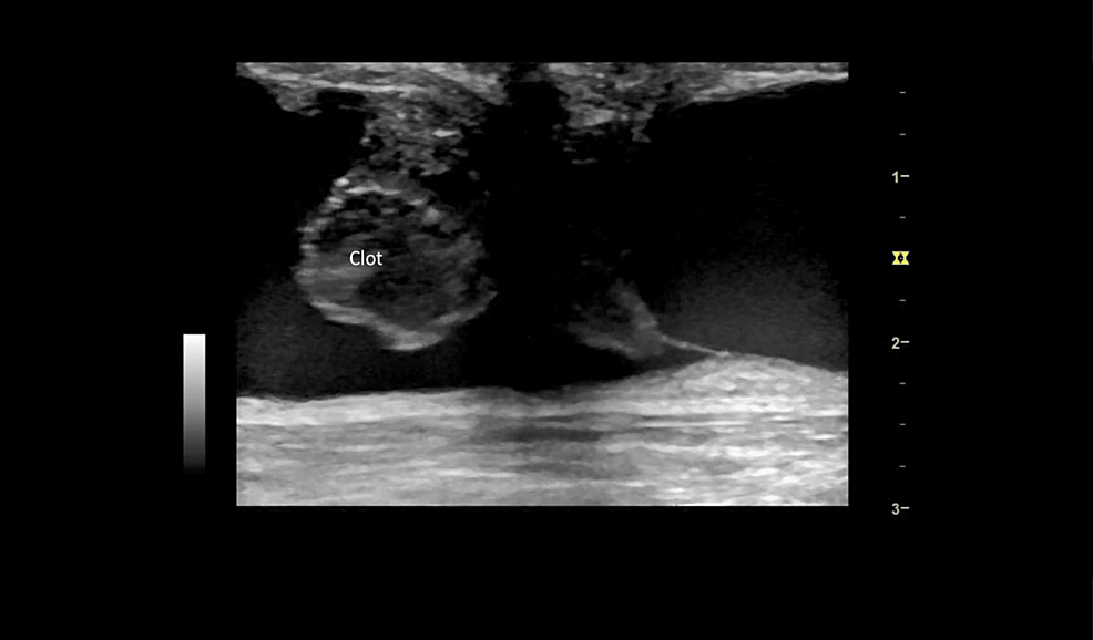 Bradycardia As A Rare Sign Of Pulmonary Embolism A Case Report Of
