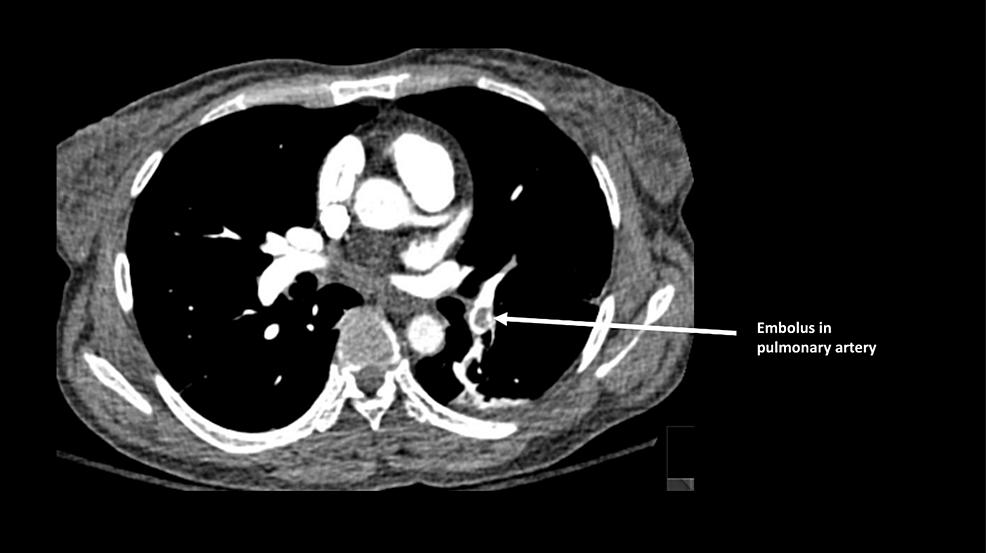 Bradycardia As A Rare Sign Of Pulmonary Embolism A Case Report Of