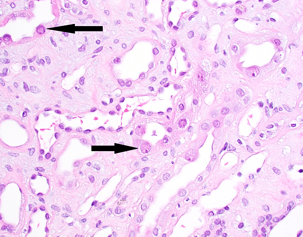 kidney-allograft-dysfunction-due-to-john-cunningham-jc-virus