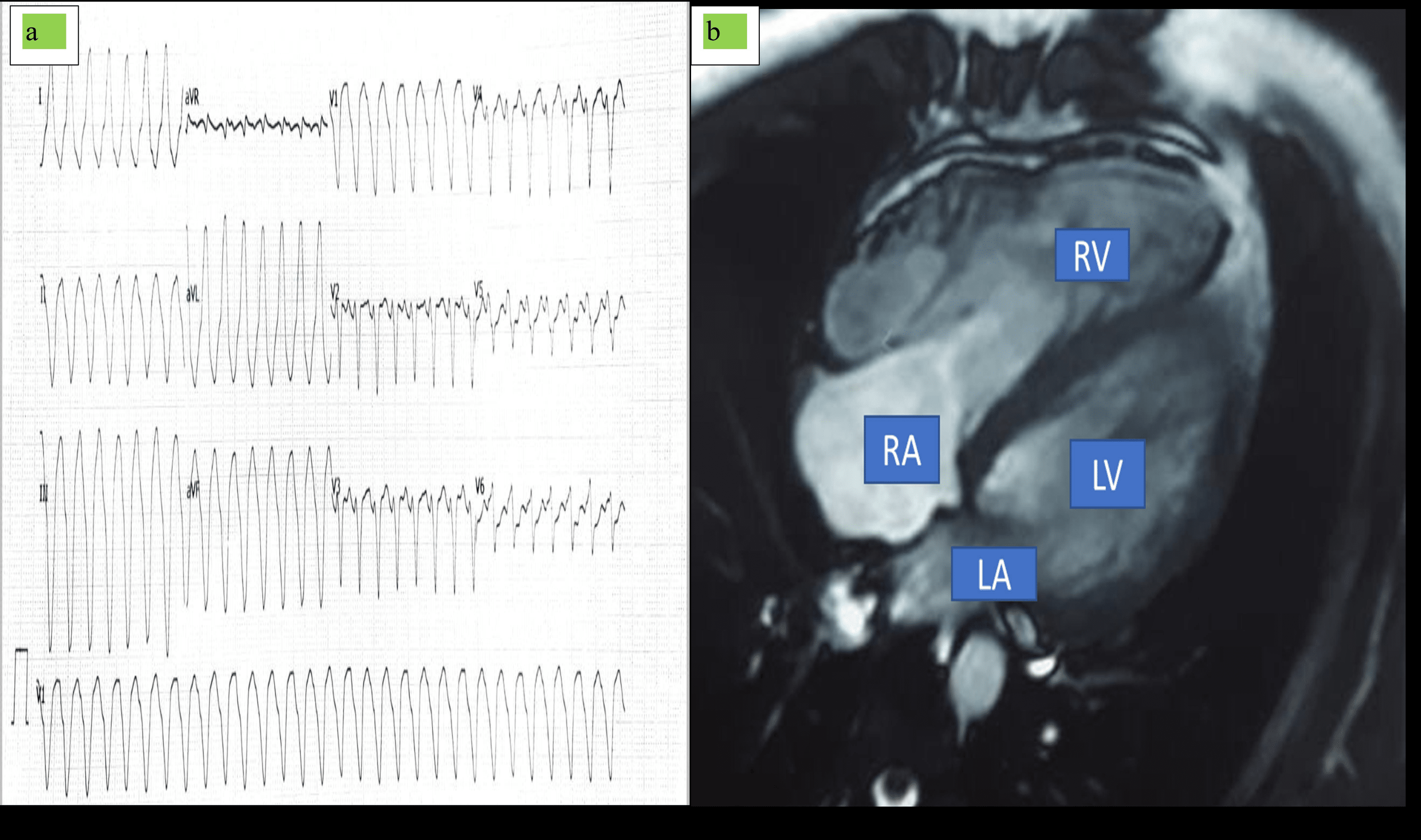 Varied Presentation of Arrhythmogenic Right Ventricular Dysplasia ...