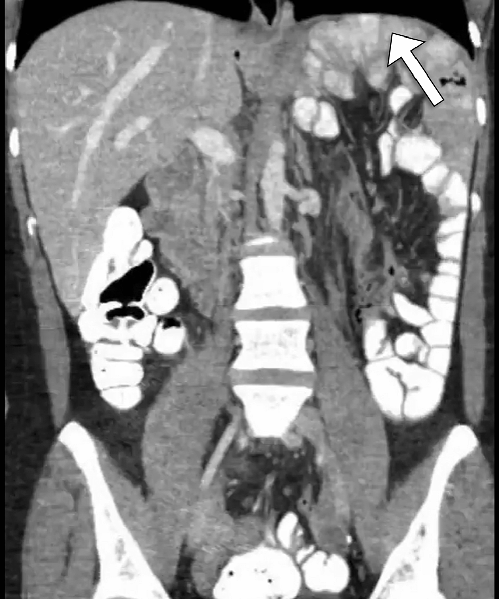 Wandering Spleen: A Rare Case From the Emergency Department | Cureus