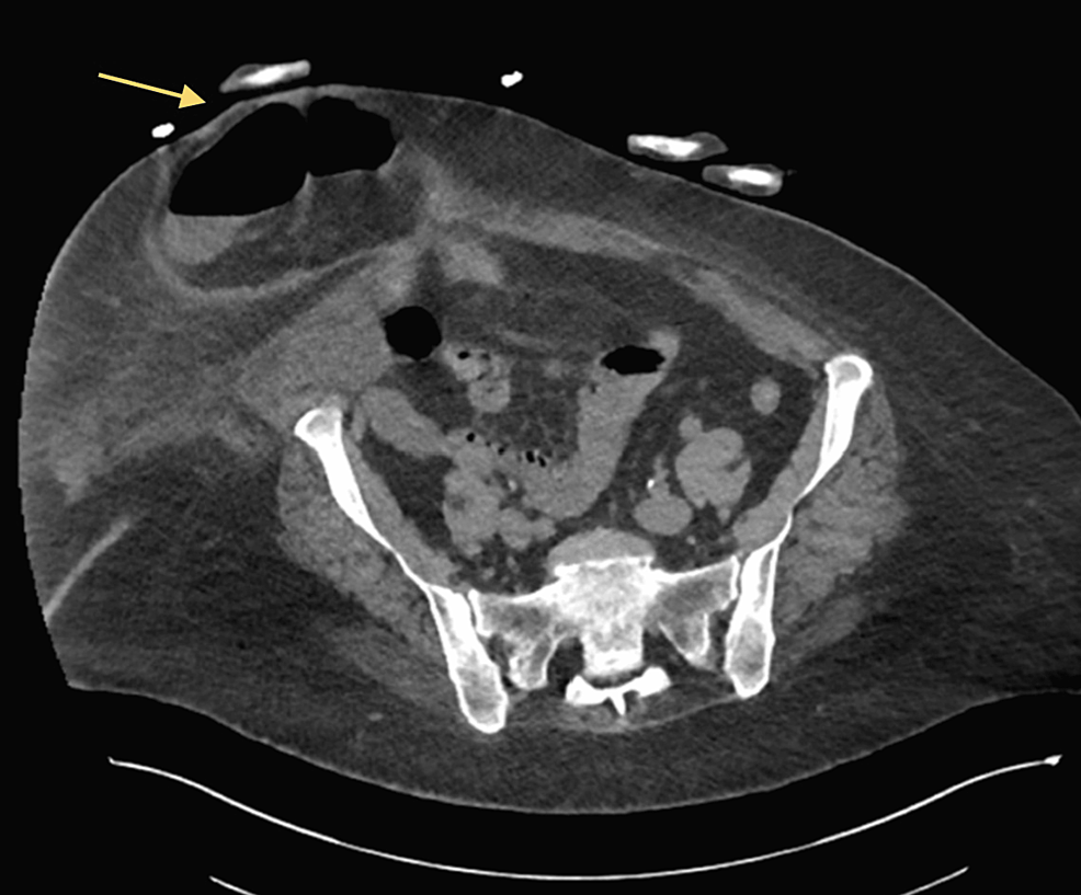 Strangulated Caecum, Appendix, and Terminal Ileum in Paraumbilical ...