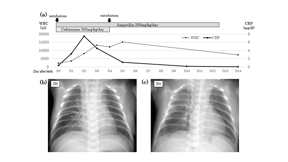 The Occurrence of Early-Onset Neonatal Streptococcus pneumoniae ...