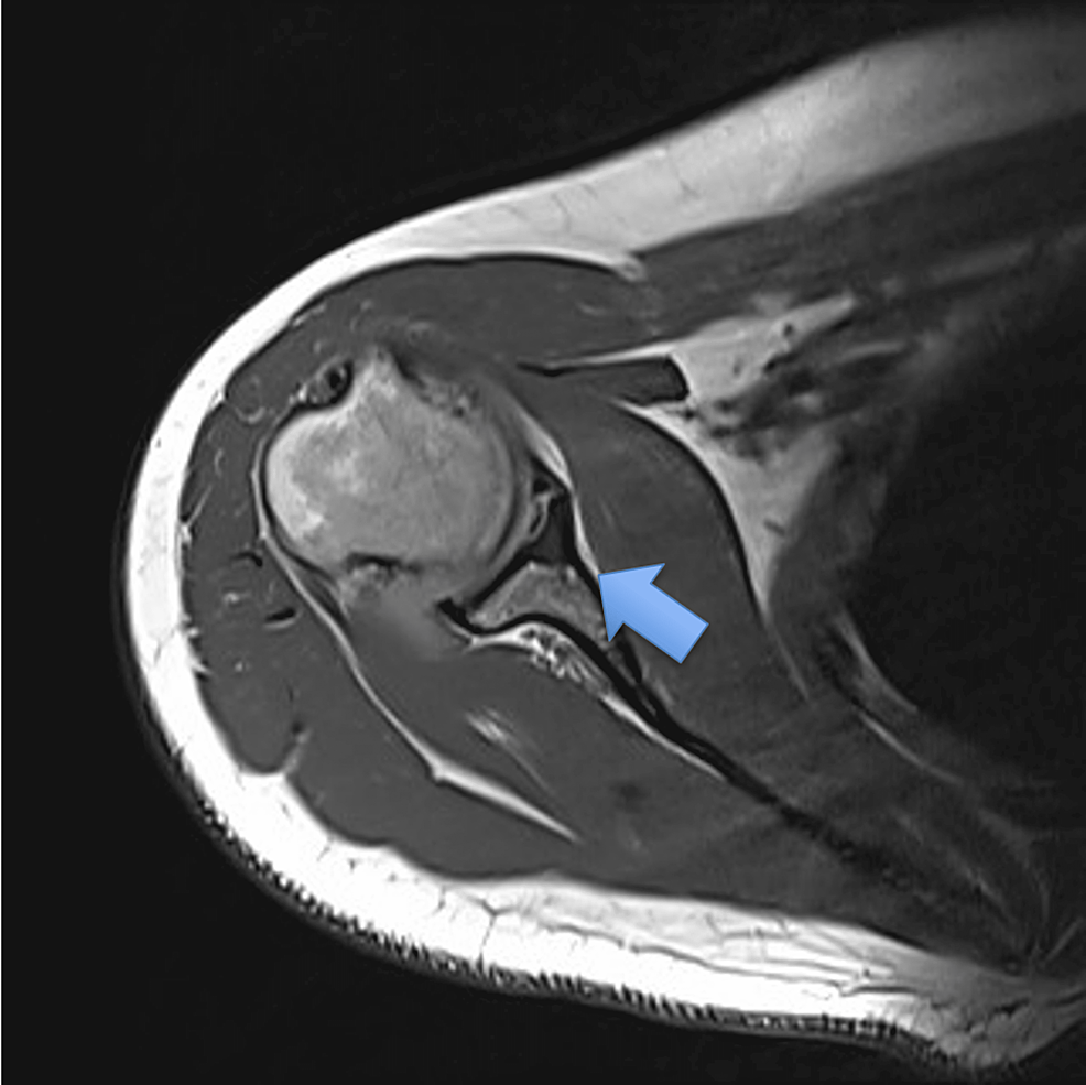 Cureus Shoulder Agony A Painful Glenoid Cyst