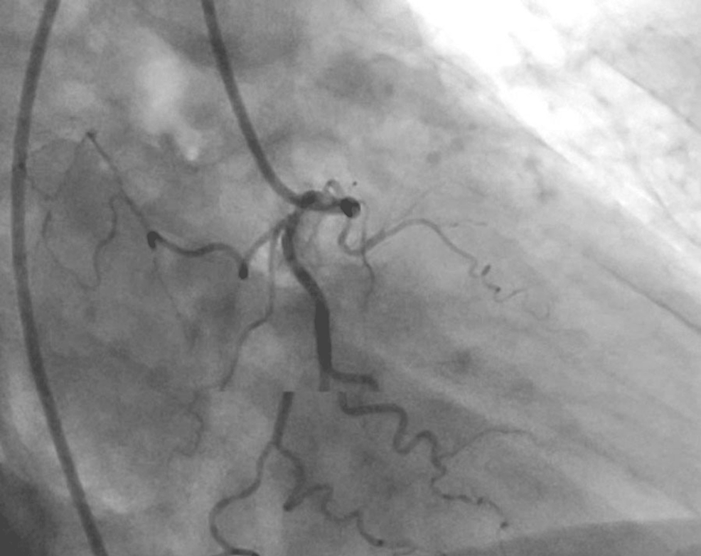 A Case Report of Takotsubo Cardiomyopathy With Myxedema Coma | Cureus