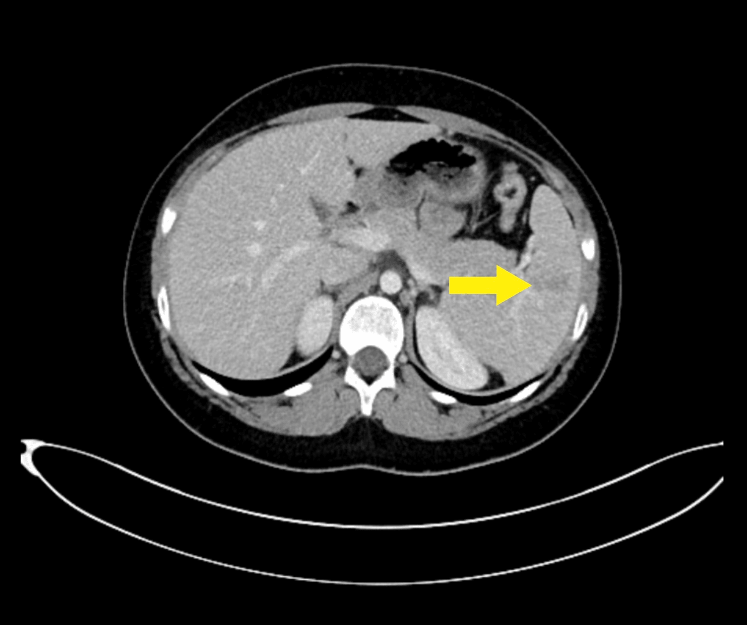 Cureus | Splenic Heterogeneity in Focused Assessment With Sonography ...