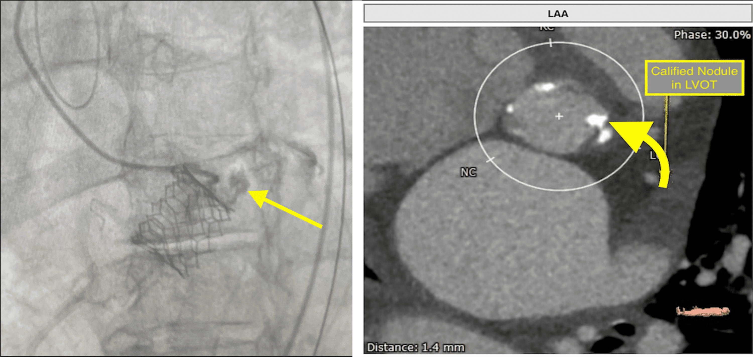 Cureus | Annular Rupture Due to Calcified Nodule Located in Left ...