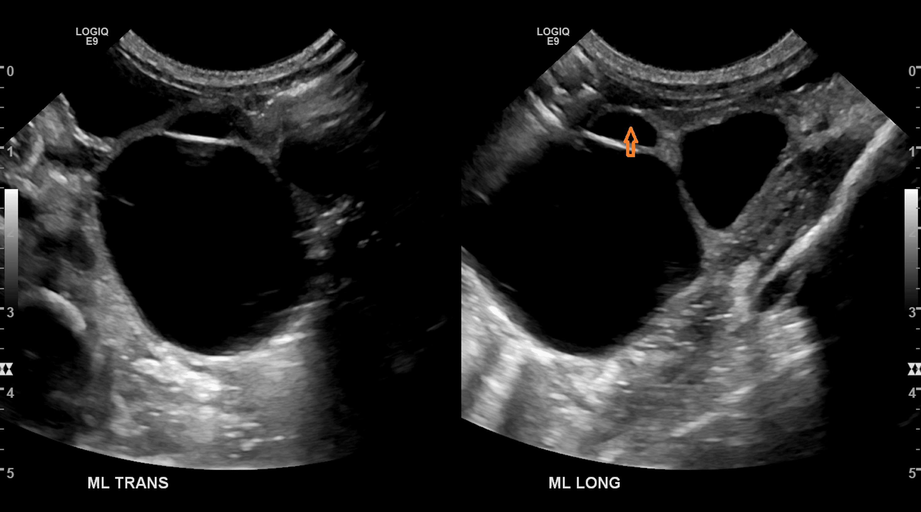 Cureus | Obstructed Hemivagina and Ipsilateral Renal Agenesis Syndrome ...