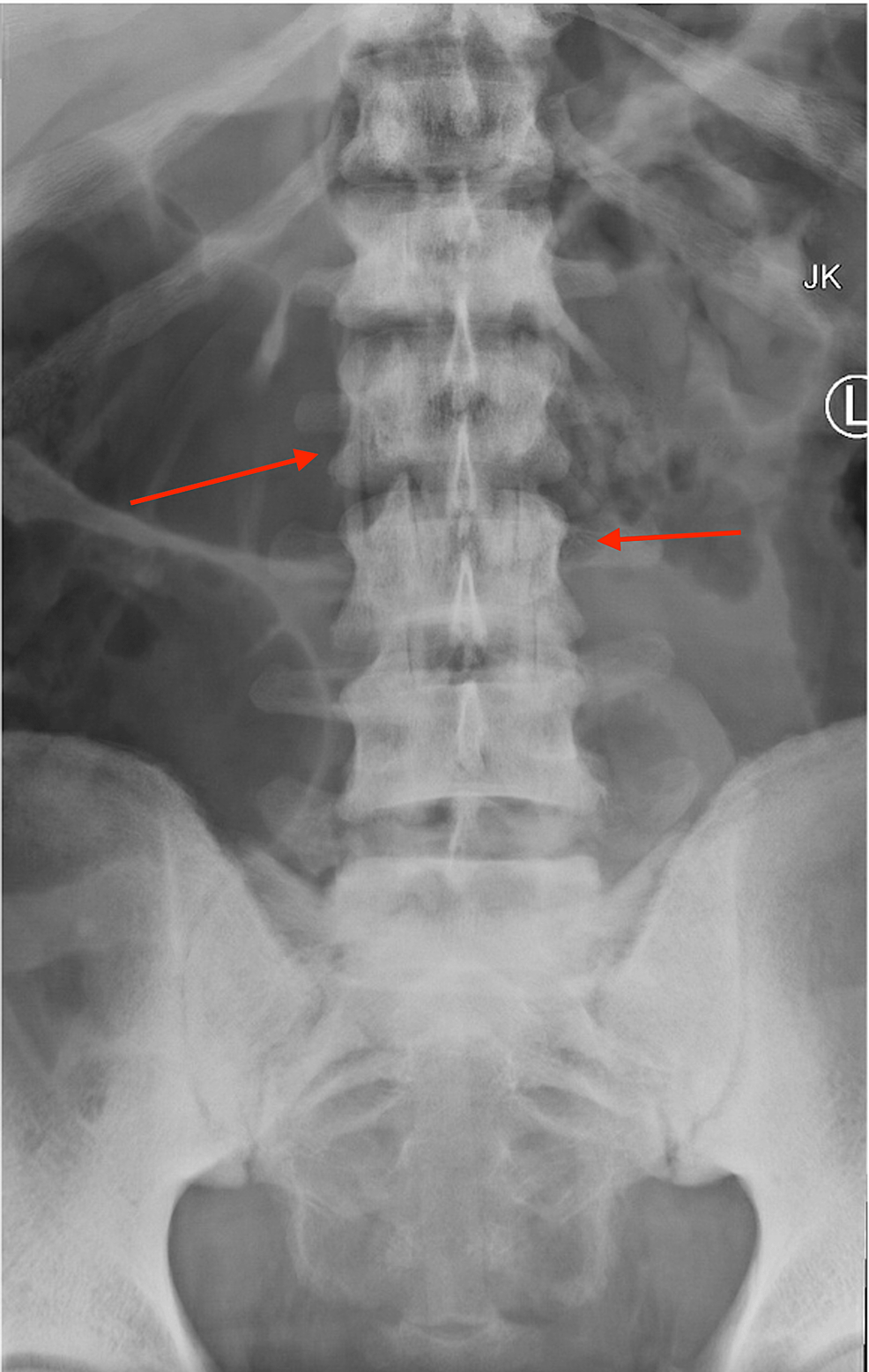 Acute Traumatic Spondyloptosis A Case Report Article Cureus Acute Traumatic Spondyloptosis A Case Report Article Cureus