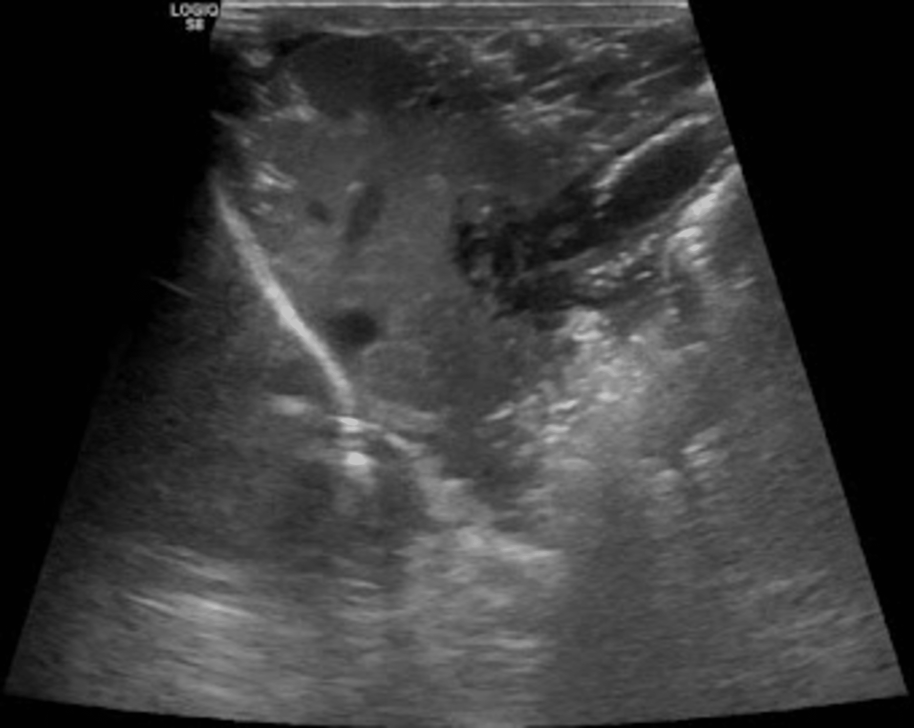 Ultrasound Findings in a Neonate During Anaphylactic Reaction to Total ...