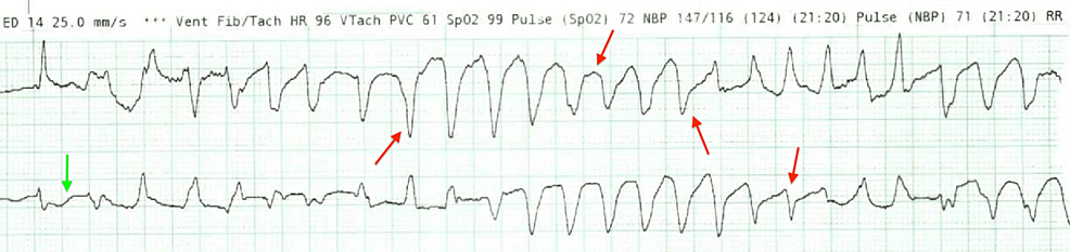 Cureus | A Coronary Cameral Fistula Associated With Incessant ...