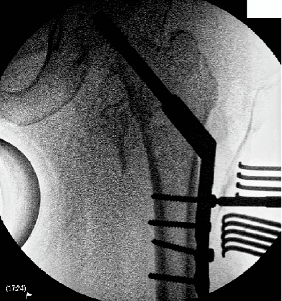 Iatrogenic Injury to Profunda Femoris During a Dynamic Hip Screw ...