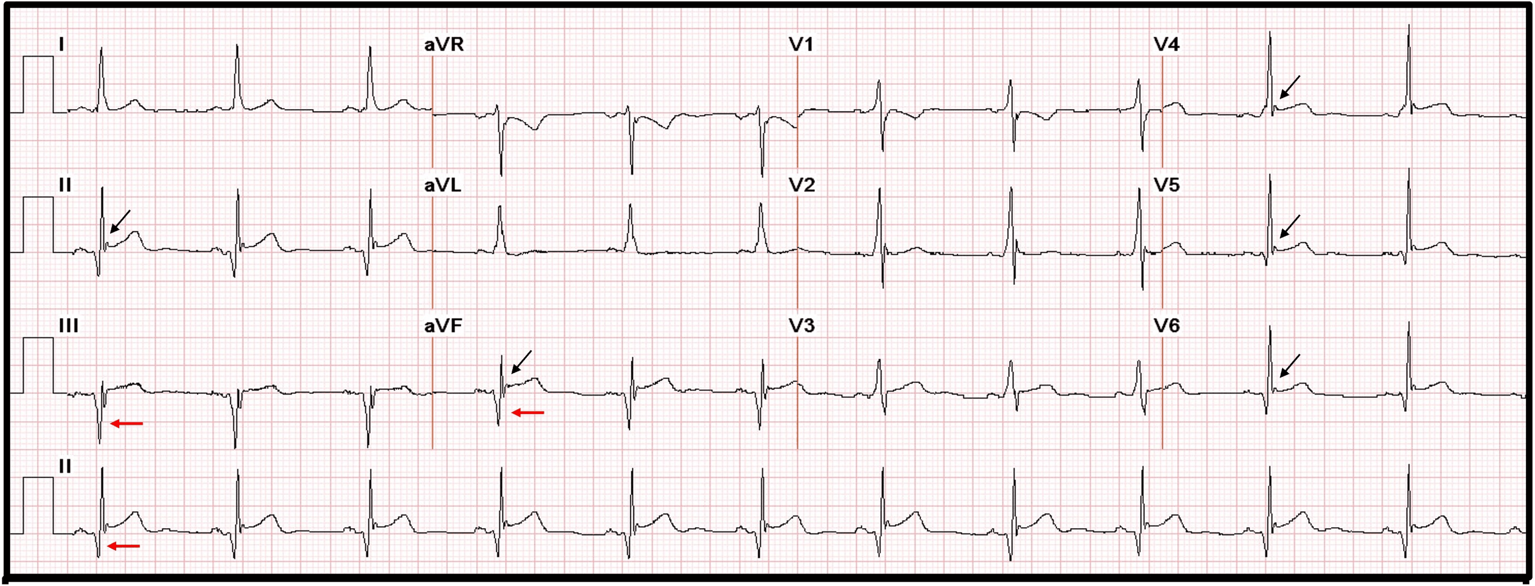 Electrocardiographic Early Repolarization in an Emergency Setting: The ...