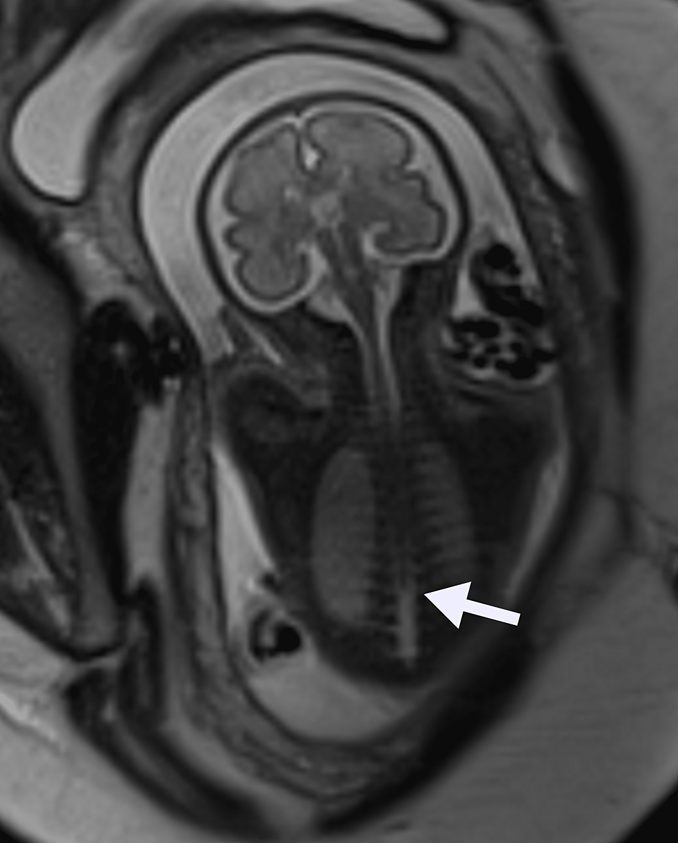Cureus | Fetal Magnetic Resonance Imaging in Association With Antenatal ...
