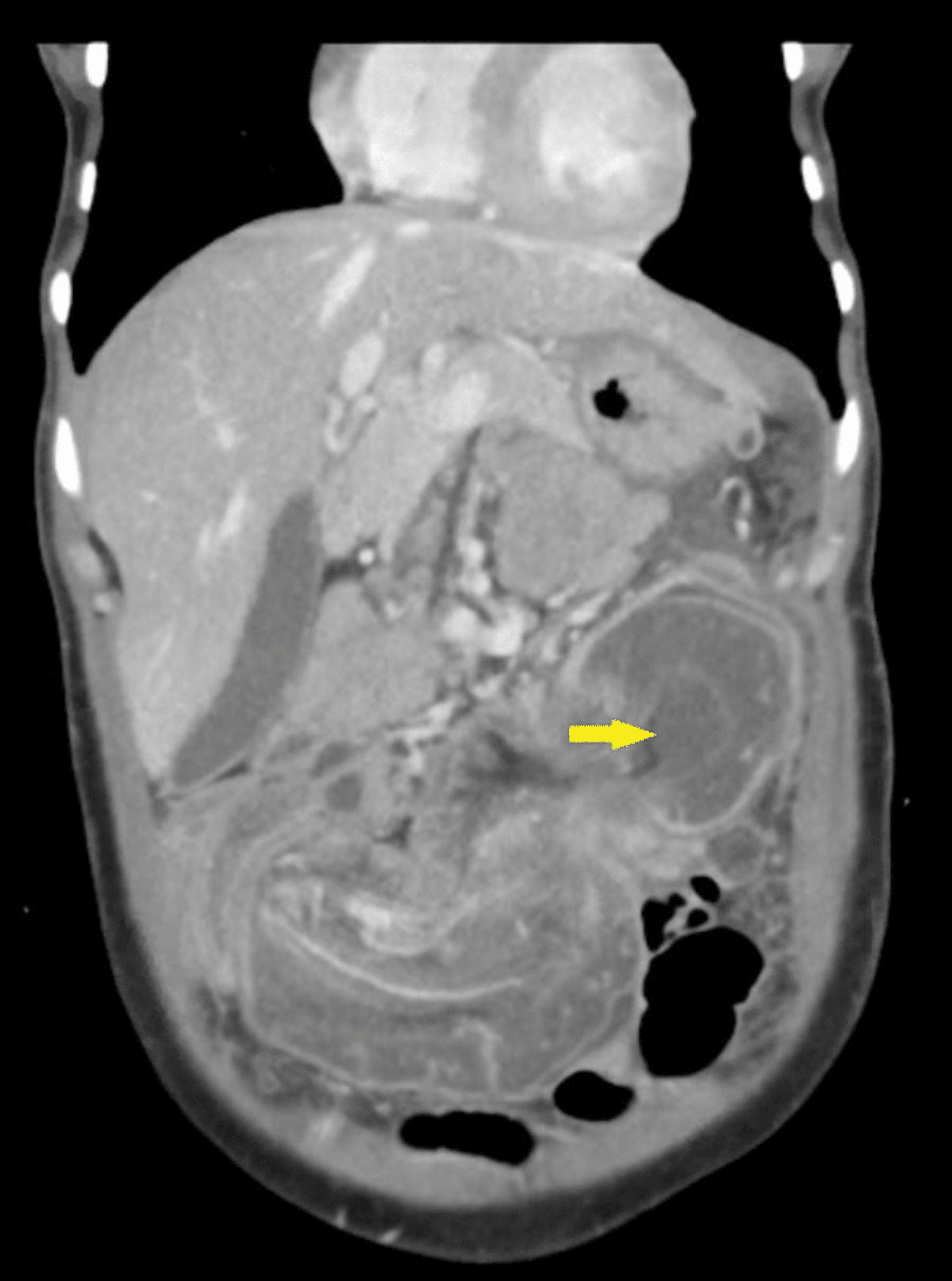 Cureus | Double Intussusceptions in a 20-Year-Old Lady Harboring a ...