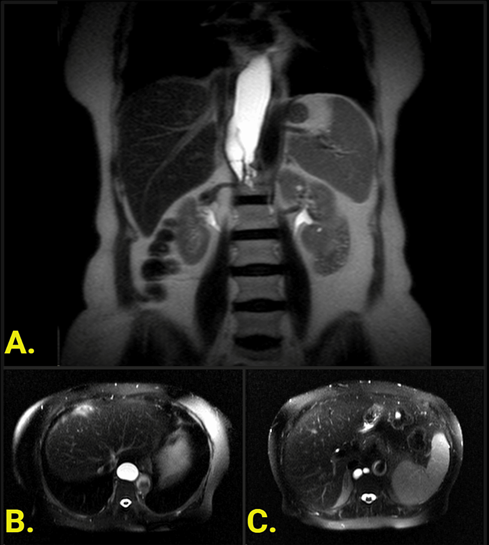Cureus Mega Cisterna Chyli A Case Report And Review Of The Literature