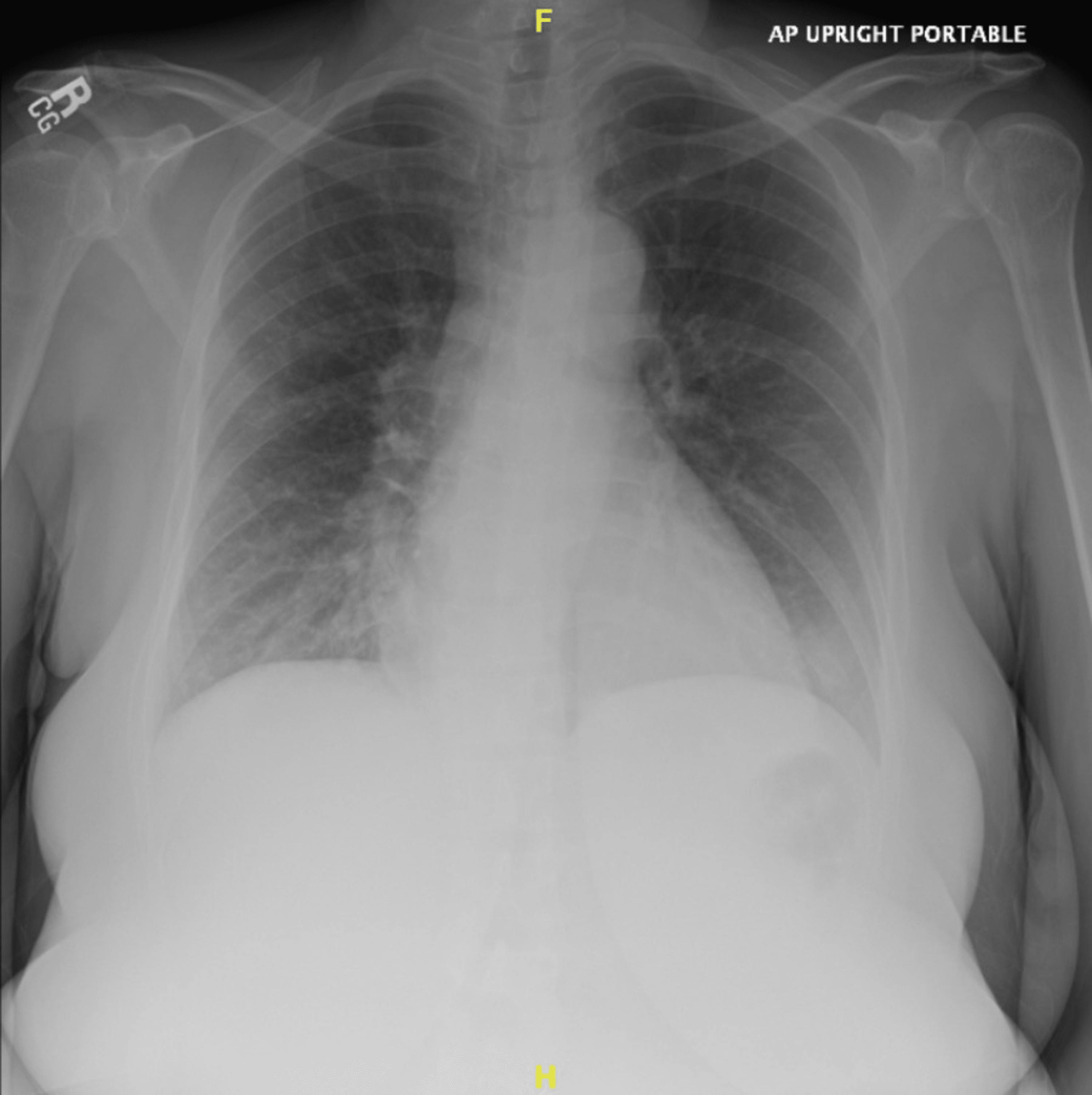 Cureus | Atypical Manifestations of Primary Pulmonary Adenocarcinoma ...