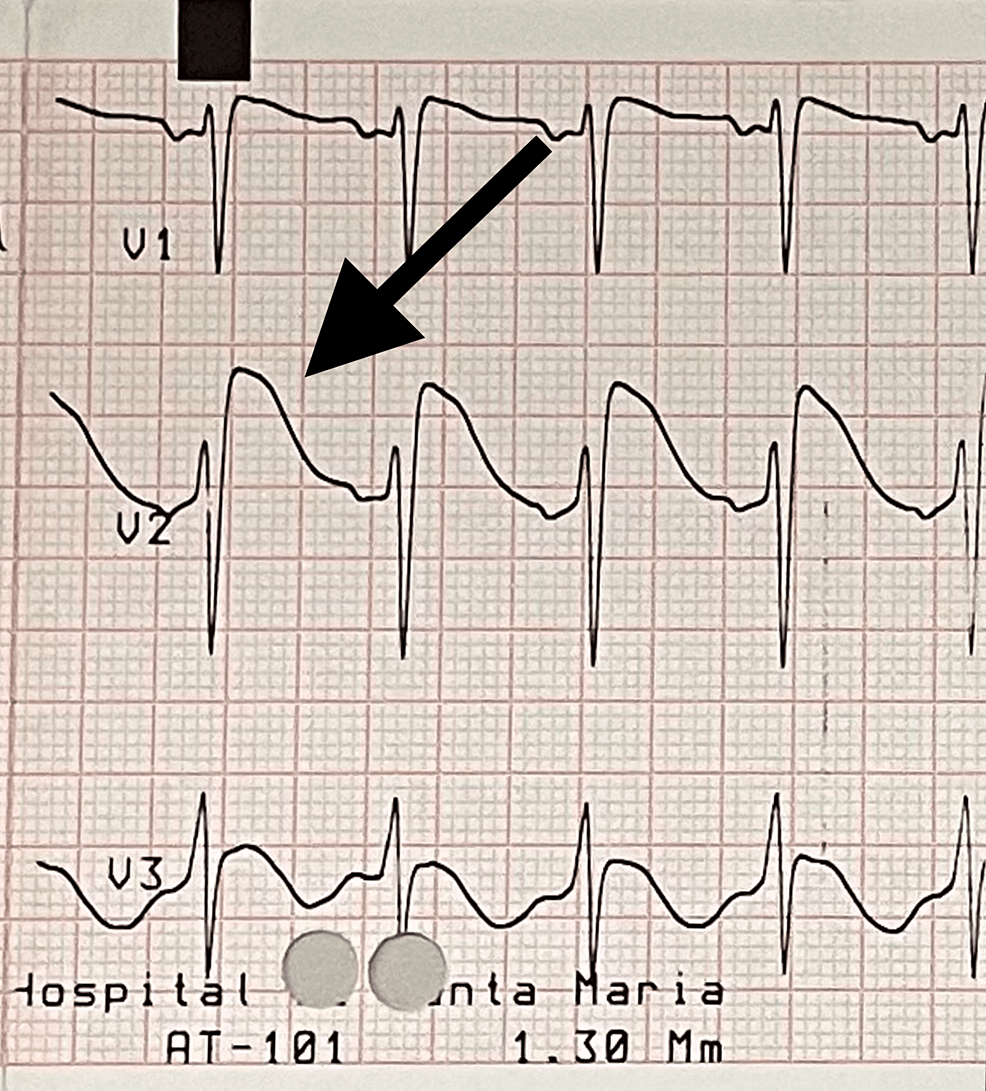 Brugada Phenocopy Caused by Intracranial Hemorrhage | Cureus
