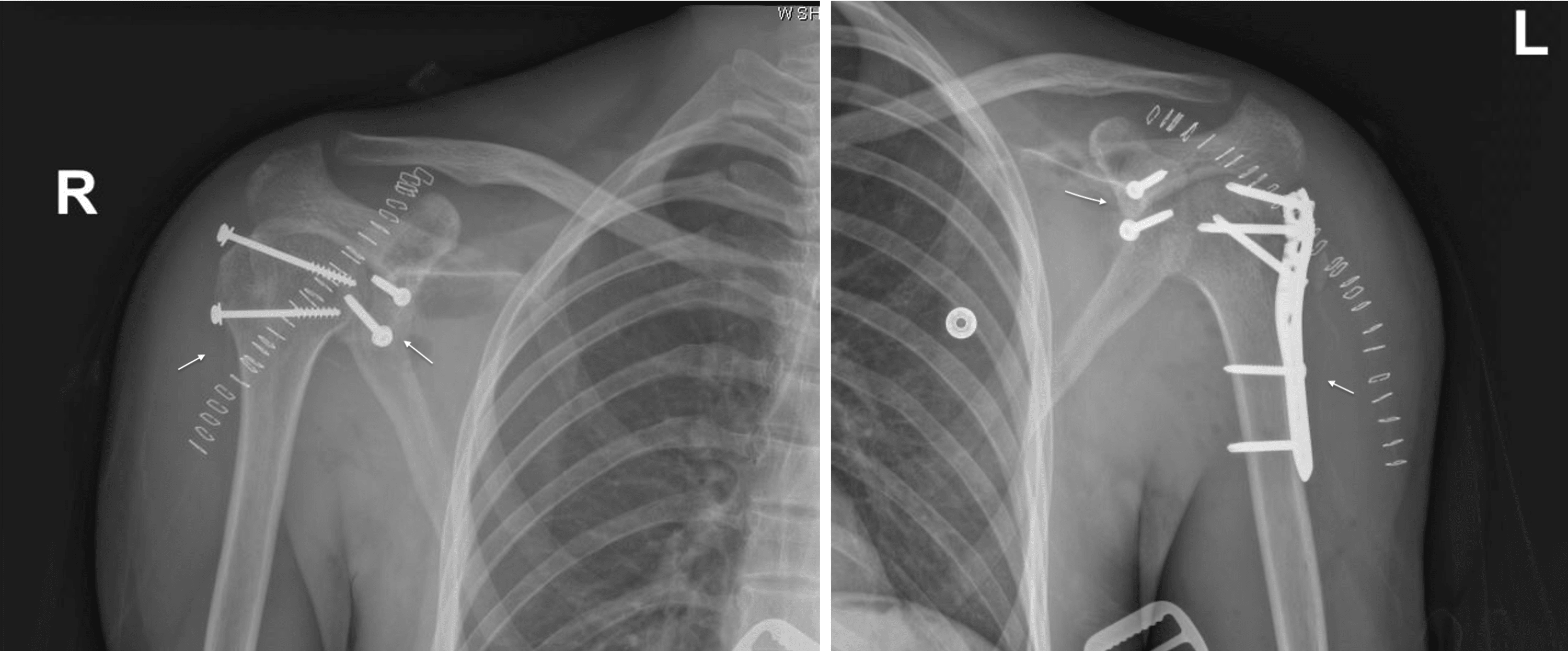 Chronic Bilateral Anterior Shoulder Fracture-Dislocation Following ...