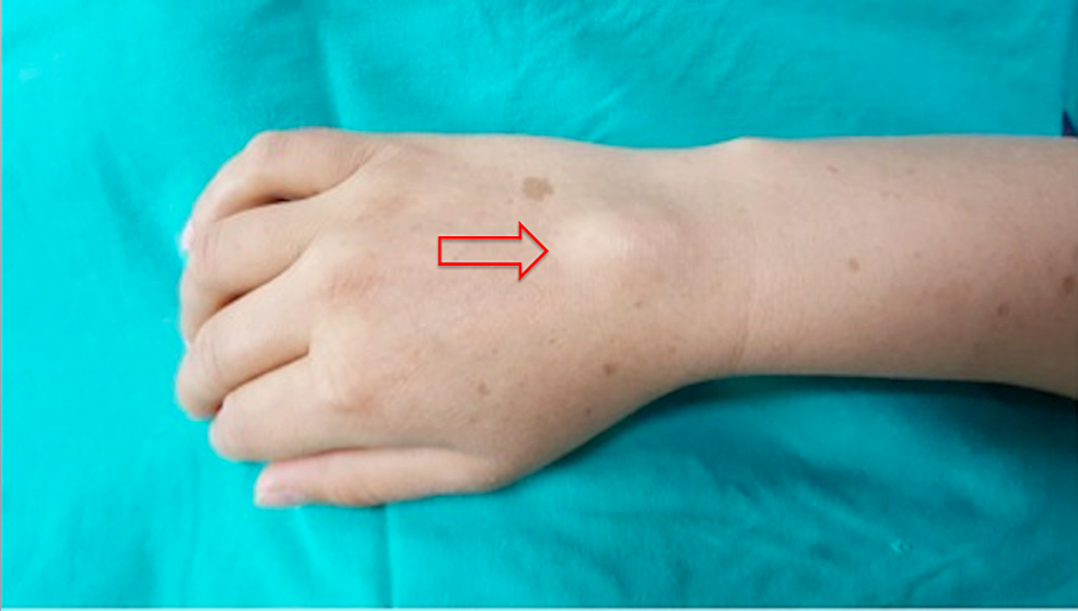 Cureus Ultrasound guided Mid humeral Radial Nerve Block Provides