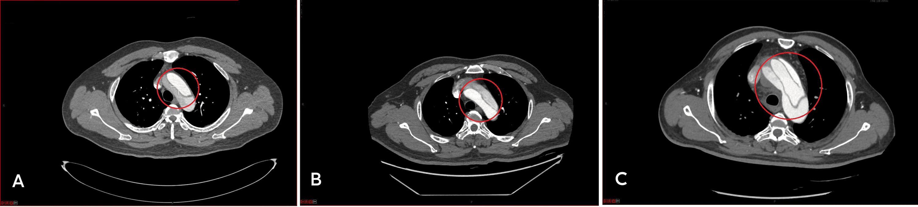 Clinical Application of Proximal Arch Cannulation in the Surgical ...