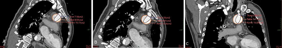 Clinical Application of Proximal Arch Cannulation in the Surgical ...