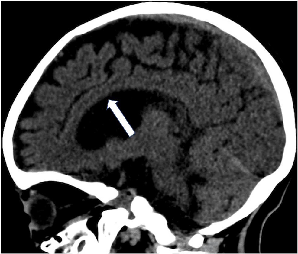 Cureus | Congenital Myasthenic Syndrome Associated With SLC25A1 Gene ...