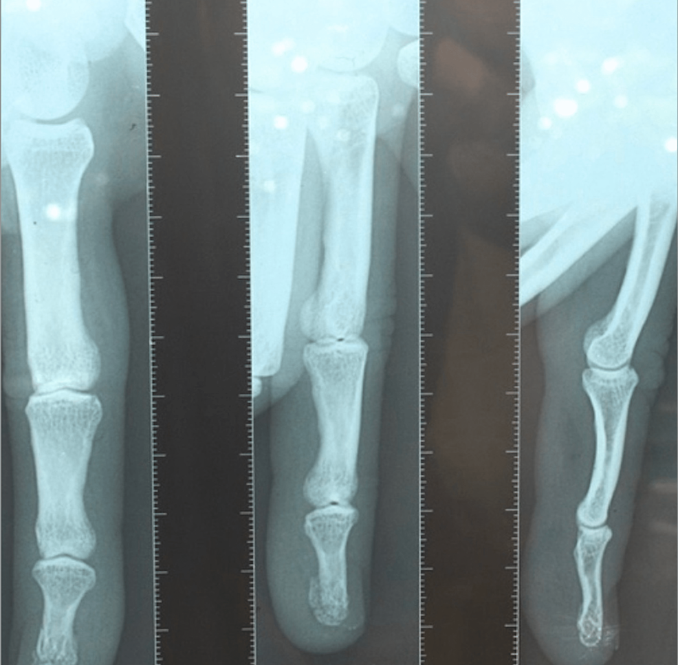 A Rare Case of an Isolated Neglected Subcutaneous Rupture of the Flexor ...