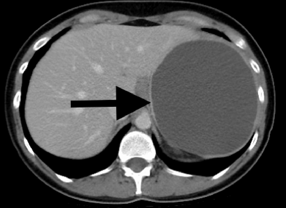 An Isolated Splenic Hydatid Cyst Article Cureus
