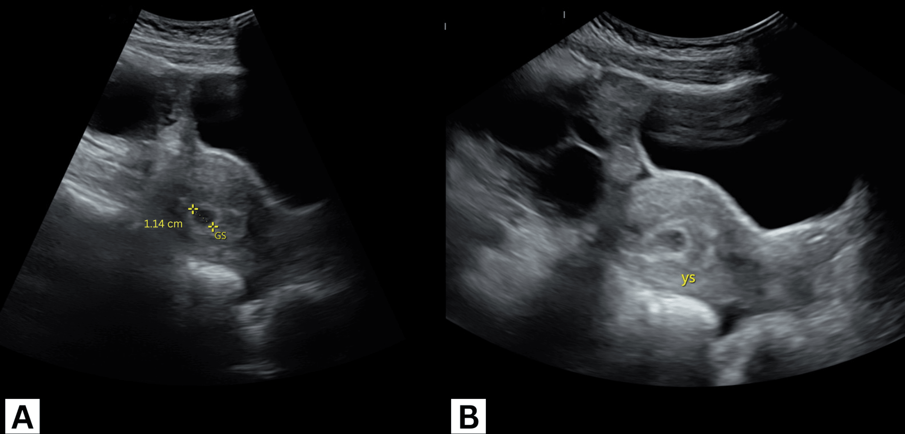 Adnexal Torsion Associated With Recurrent Ovarian Hyperstimulation ...