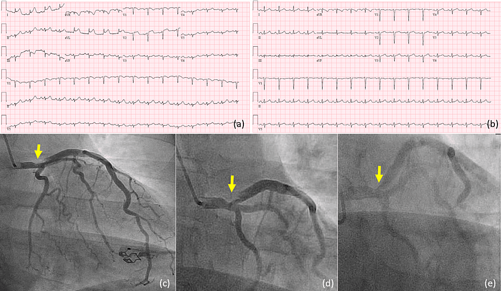 Spontaneous Coronary Artery Dissection in Young Patients: A Case Series ...