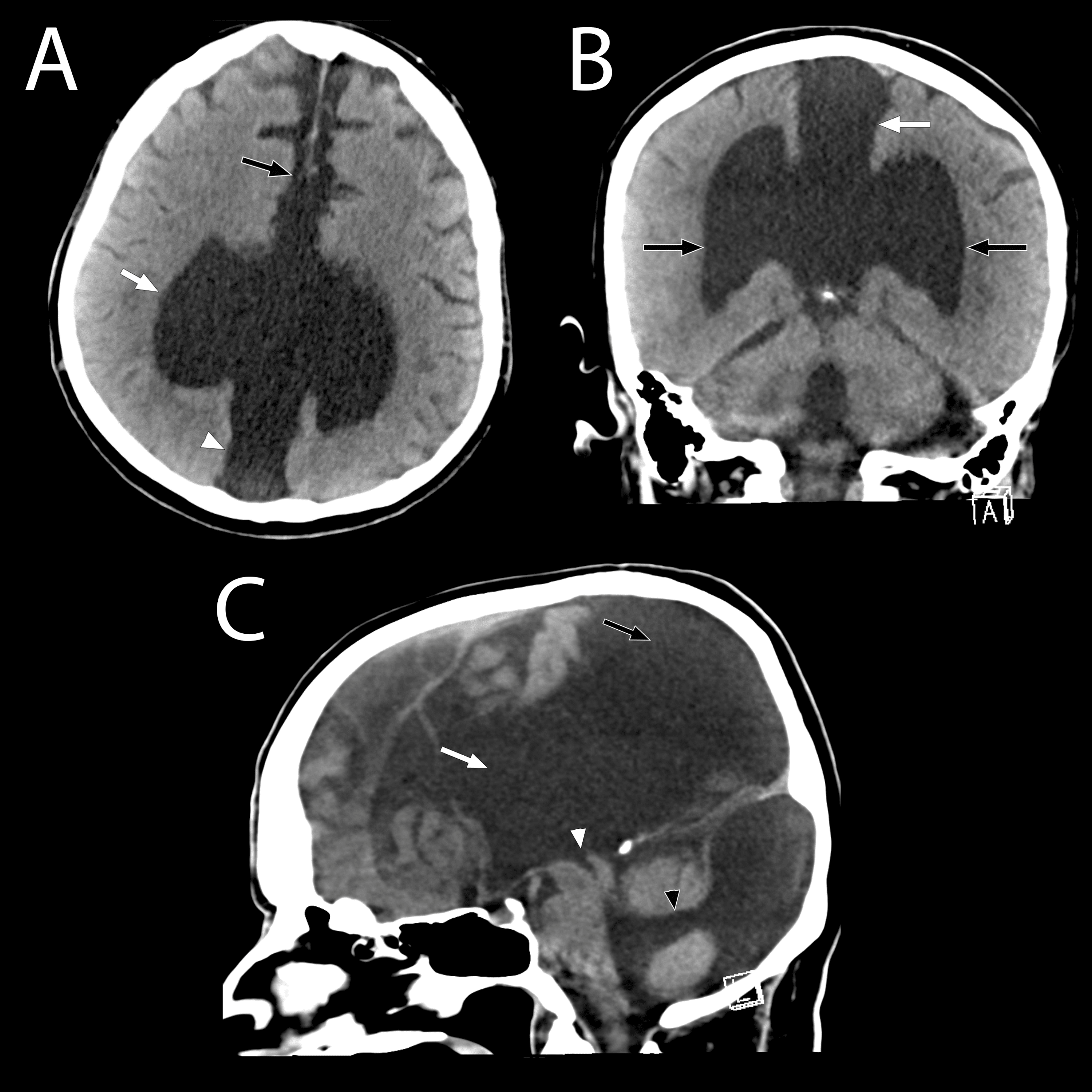 Adult Radiographic Presentation of Corpus Callosal Agenesis With a ...