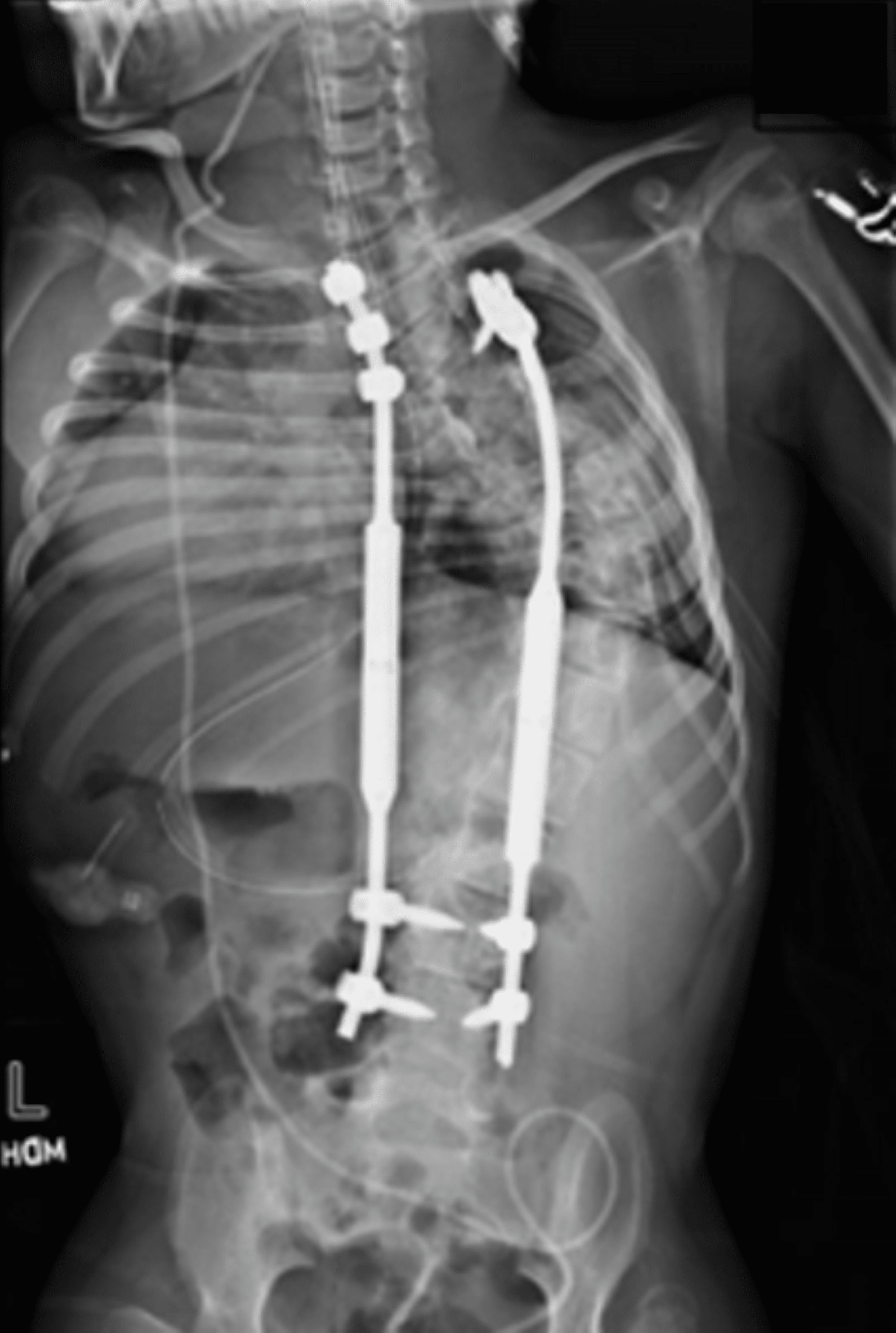 Autofusion With Magnetically Controlled Growing Rods: A Case Report ...