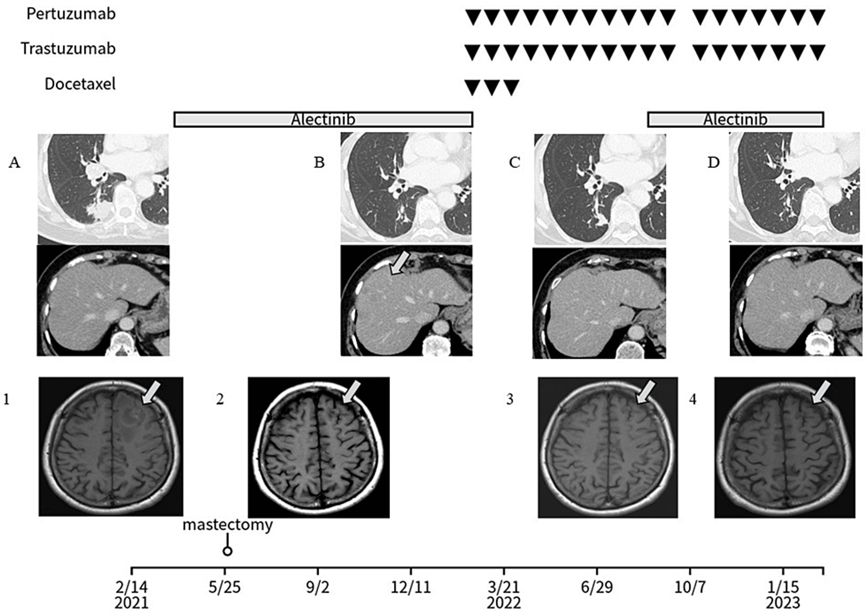 ALK-Rearranged NSCLC With Concomitant HER2-Mutant Breast Cancer Patient ...