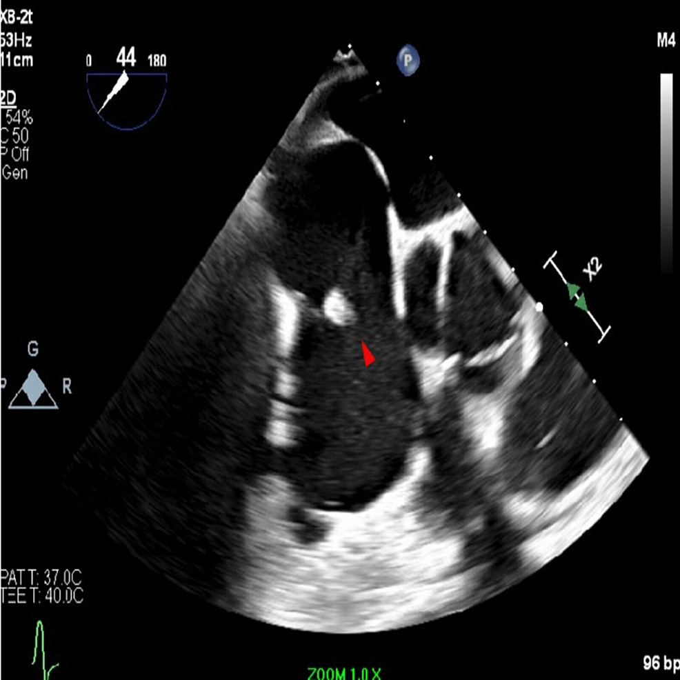 Cureus | Eustachian Valve Endocarditis in a Patient With Charcot-Marie ...