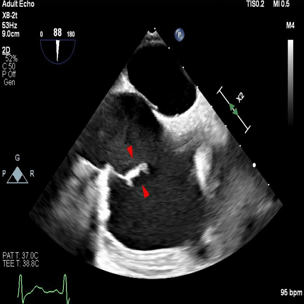 Eustachian Valve Endocarditis in a Patient With Charcot-Marie-Tooth ...
