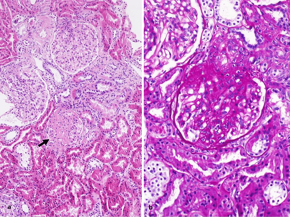 Rheumatoid Arthritis With Focal Segmental Glomerulosclerosis: A Case ...