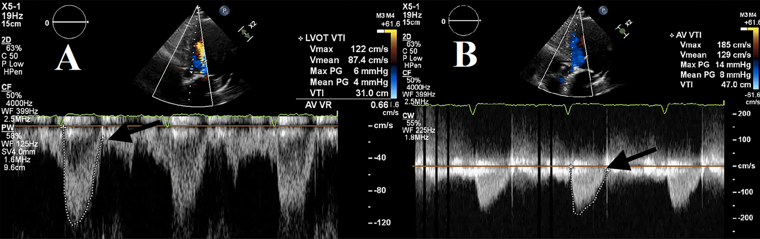 Transcatheter Aortic Valve Migration During Vascular Access Closure ...