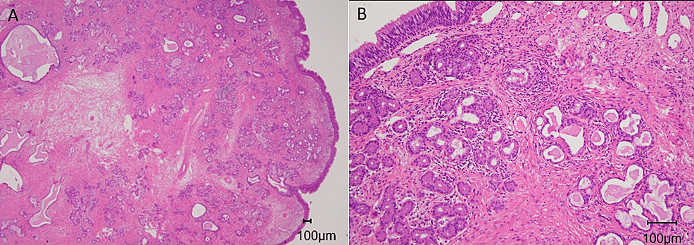 Septochoanal Polyp on the Concave Side of the Deviated Nasal Septum ...