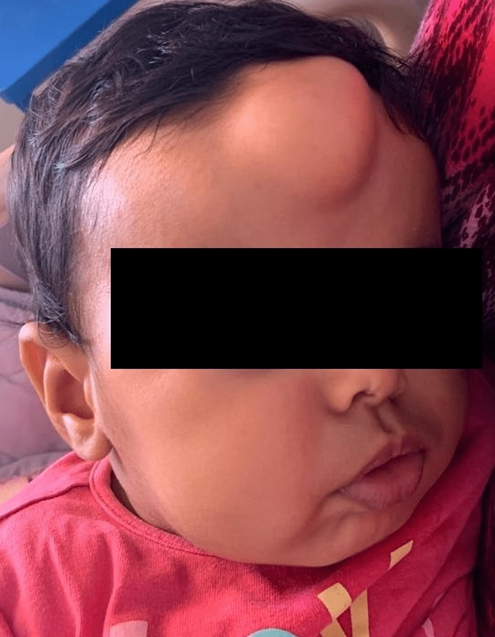 Cureus Deep Frontal Lipoma With Frontal Bone Invasion Report Of A Cureus Deep Frontal Lipoma With Frontal Bone Invasion Report Of A