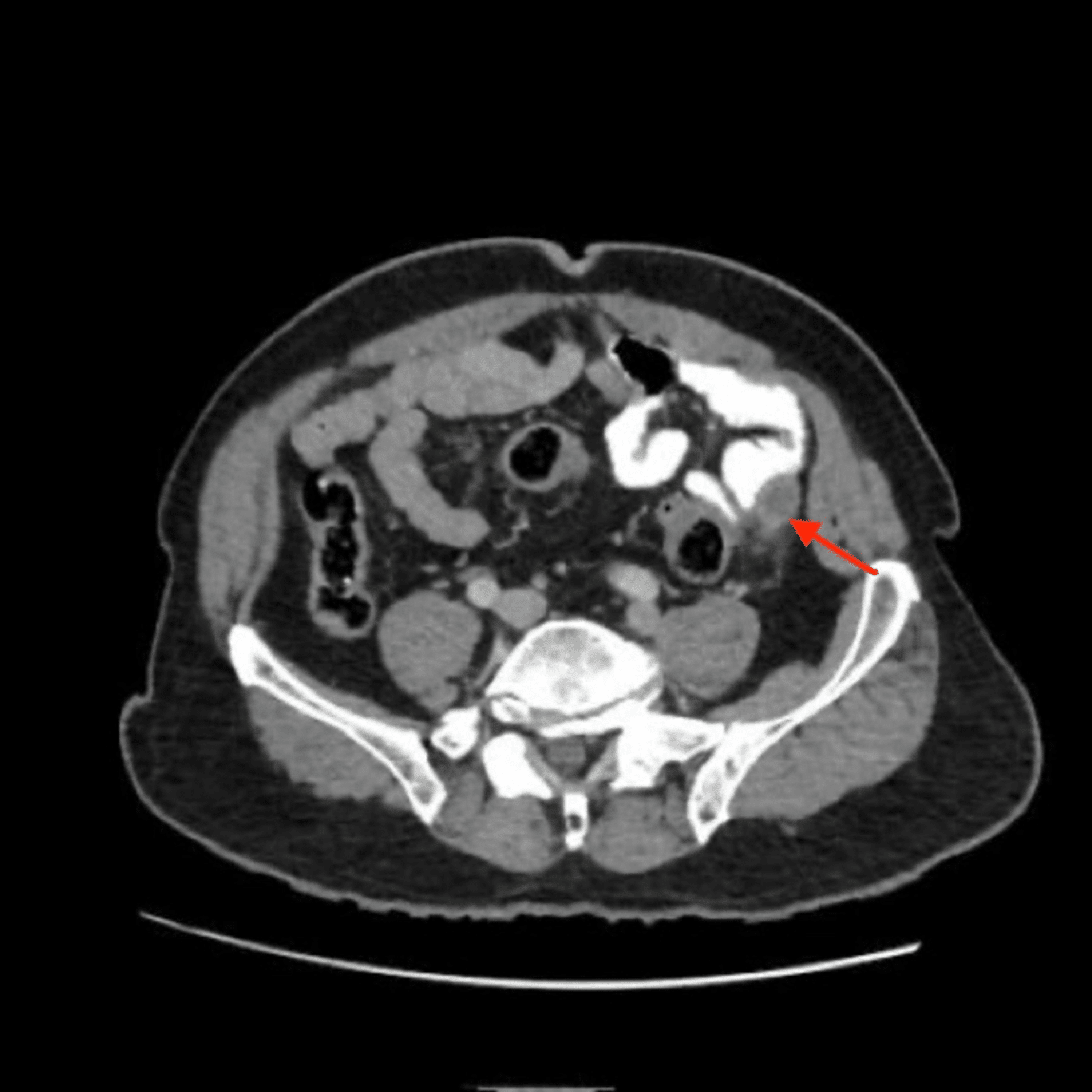 Cureus | Left-Sided Acute Appendicitis in a Patient With Situs Inversus ...