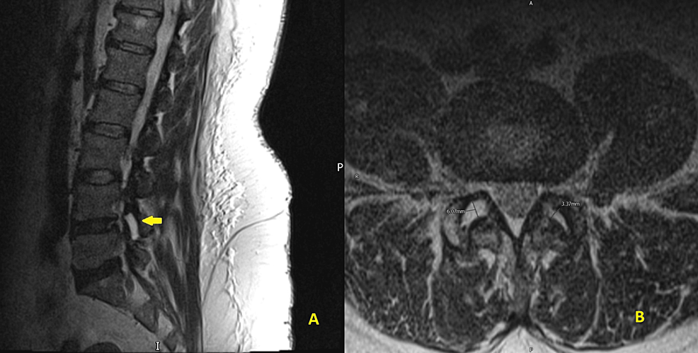 Lumbar Facet Joint Fluid: A Reliable Sign of Lumbar Instability | Cureus