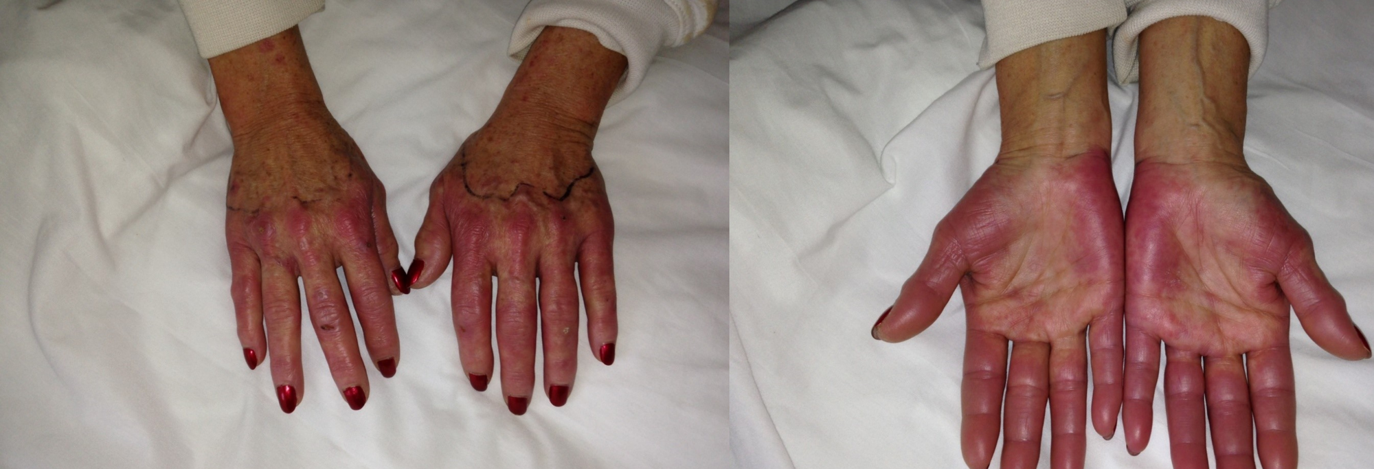 Hand Foot Syndrome