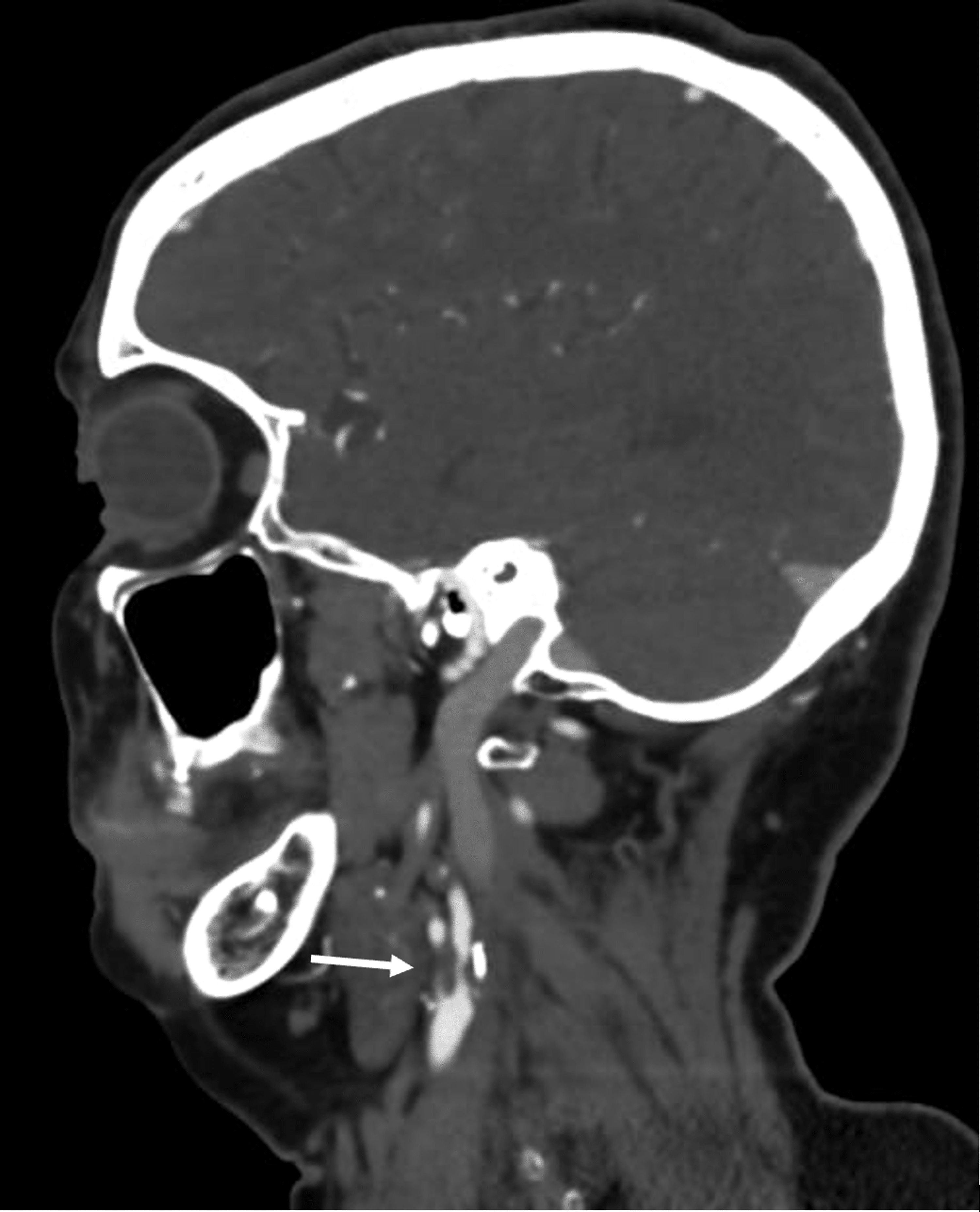 Hand Knob Syndrome Secondary to Ipsilateral Concomitant Carotid ...