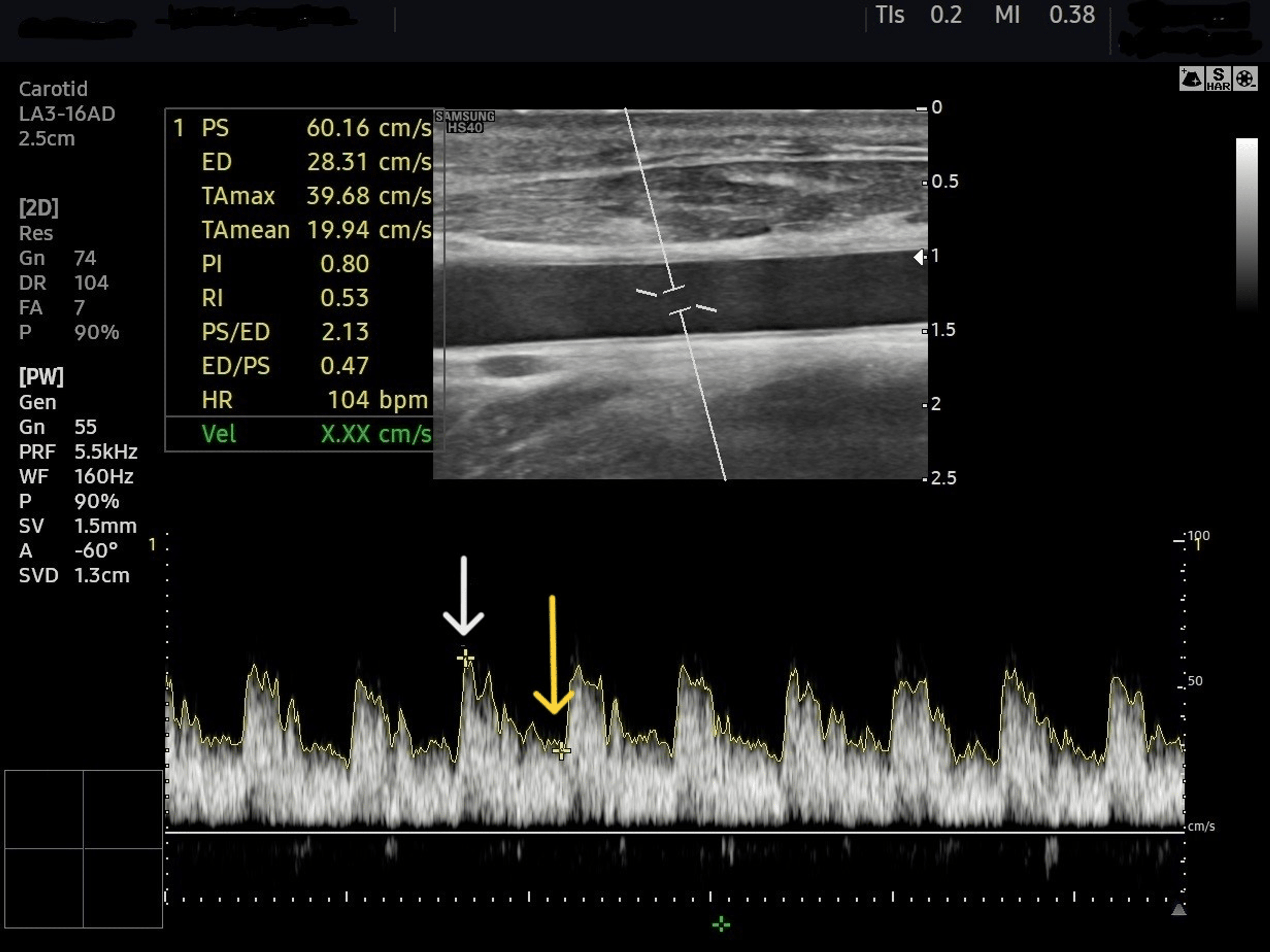 Cureus | Correlation of Common Carotid Artery Blood Flow Parameters ...