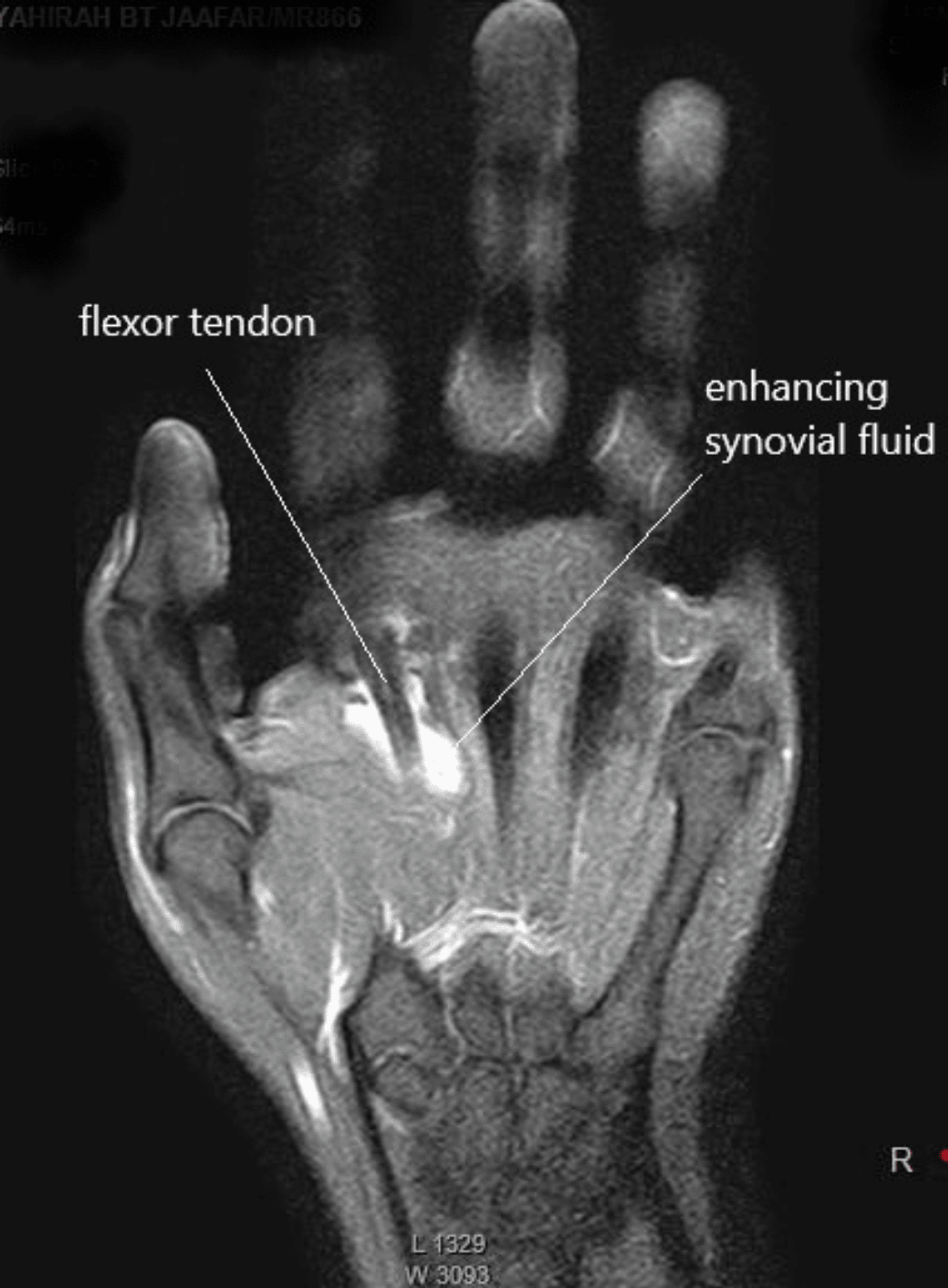 A Rare Cause of Chronic Flexor Tenosynovitis of the Finger | Cureus