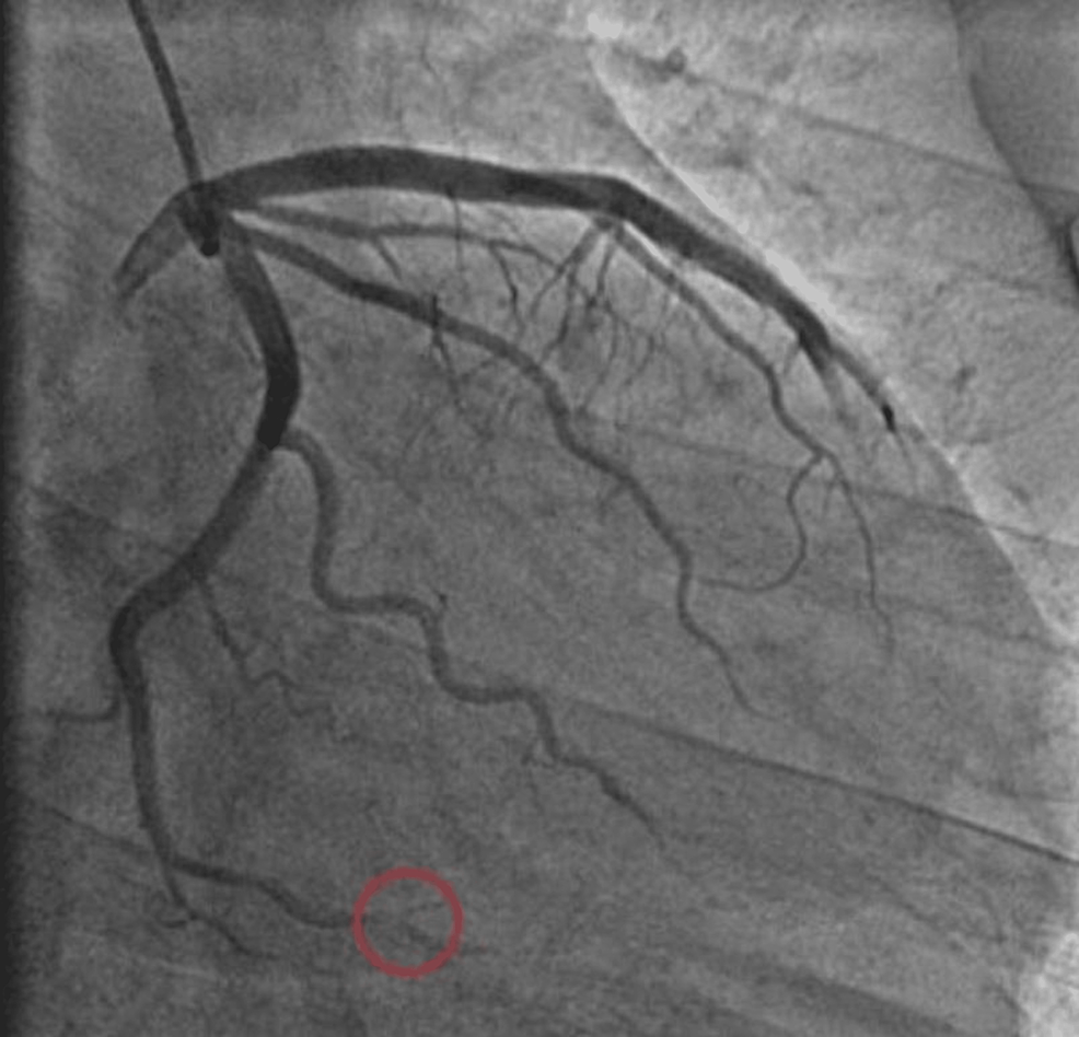 Cureus Acute Myocardial Infarction As The First Presentation Of