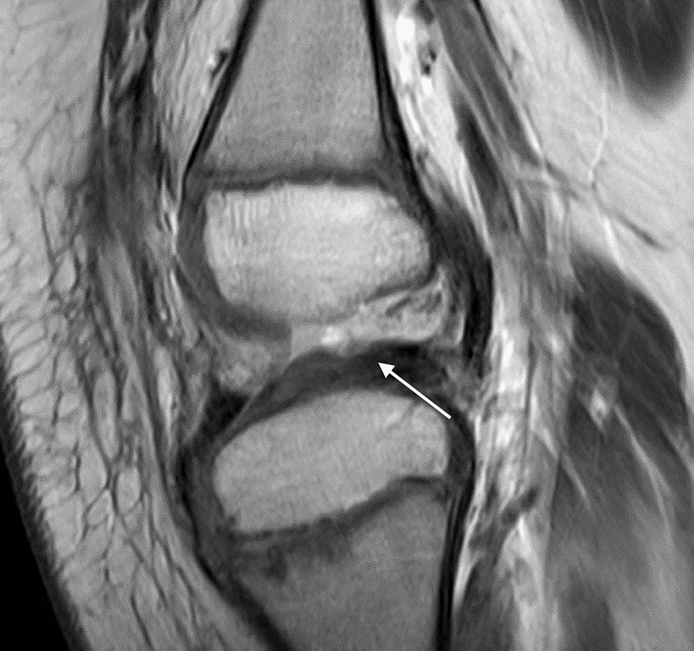 Cureus | The Novel Use of the Lateral Scanogram to Detect Cruciate ...