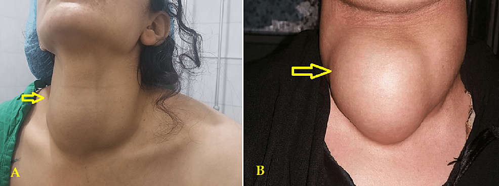 Management of Retrosternal Goiter in Resource-Limited Settings ...