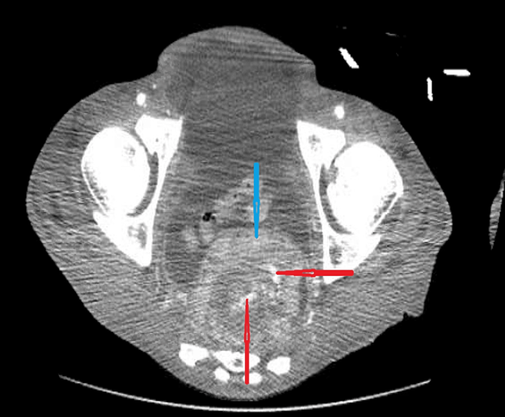 Veillonella Bacteremia in a Patient With Metastatic Colorectal ...
